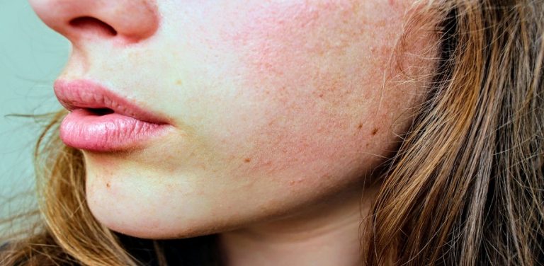 Dermatita atopica (eczema atopica) – cauze, simptome, tratament ...