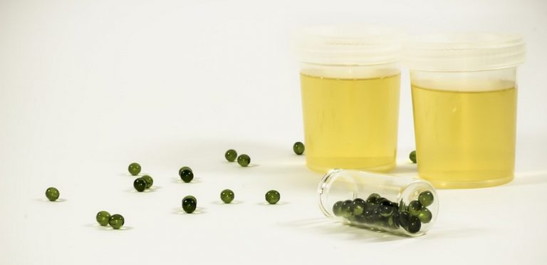 Sindromul nefrotic – ce este, cauze, simptome, tratament – Sfaturimedicale.ro