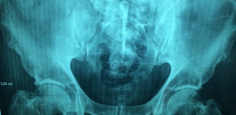 Fractura de bazin – cauze, simptome, prim ajutor, tratament ...