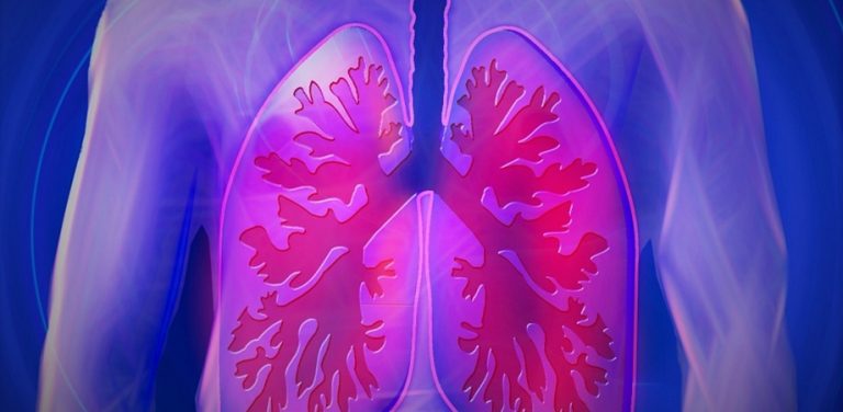Pneumonia – totul despre cauze, simptome, diagnostic si tratament ...