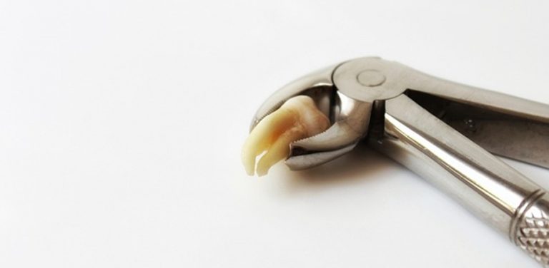 Extractia dentara – indicatii si recomandari dupa procedura ...